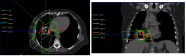 Cancer Therapy Centres Patient Scans Cancer Therapy Centres Patient Scans